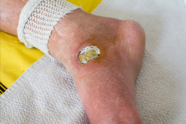 Neuropathic Ulcers: Understanding the Link Between Nerve Damage and ...