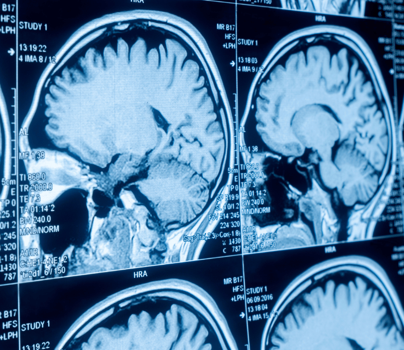 Concussion Recovery | Spine Pain & Performance Center in Geneva, IL