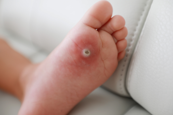 What Exactly Is a Verruca? Causes, Symptoms, and Why They Appear on the ...