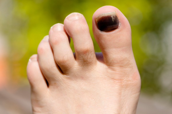 Toenail Trauma: What to Do If You’ve Injured Your Nail