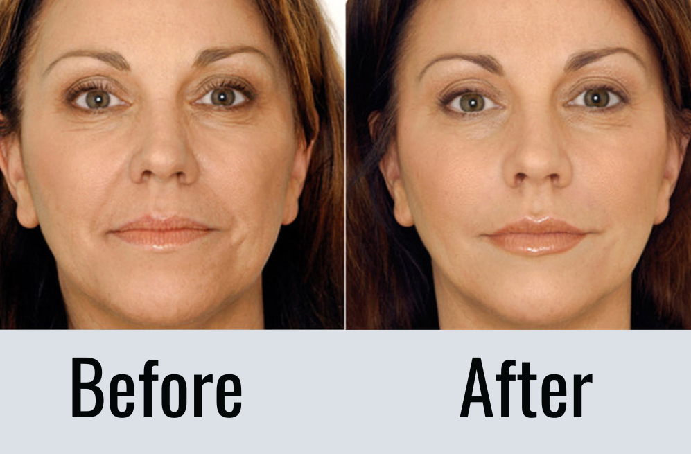 $699 Bio-Filler Face Lift - LaserSkin MedSpa