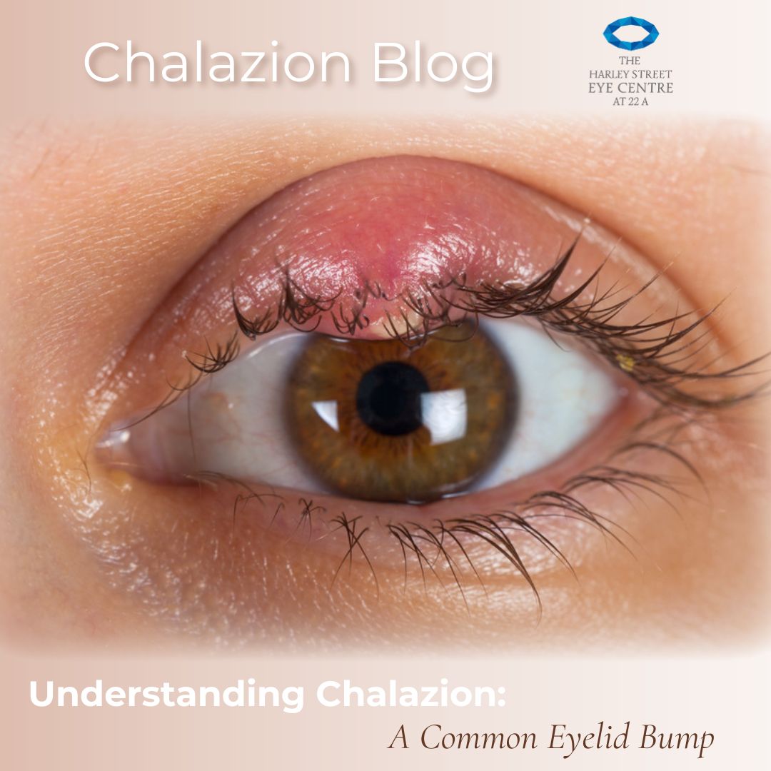 Understanding Chalazion A Common Eyelid Bump