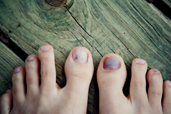 Discolored Toenails? It Might Not Be Fungus! Sorting Out Onychomycosis ...