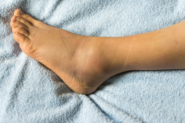 How Weak Ankles Can Lead to Big Problems (and What You Can Do About It)