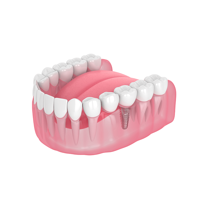 Dr. Nathan Eberle - Free Dental Implants Consultation