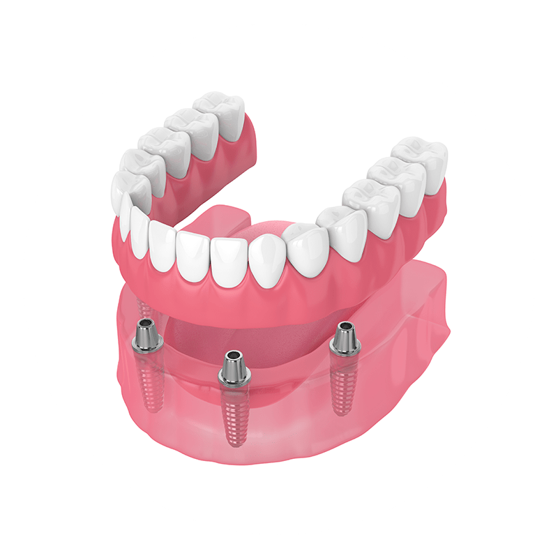 Dr. Nathan Eberle - Free Dental Implants Consultation