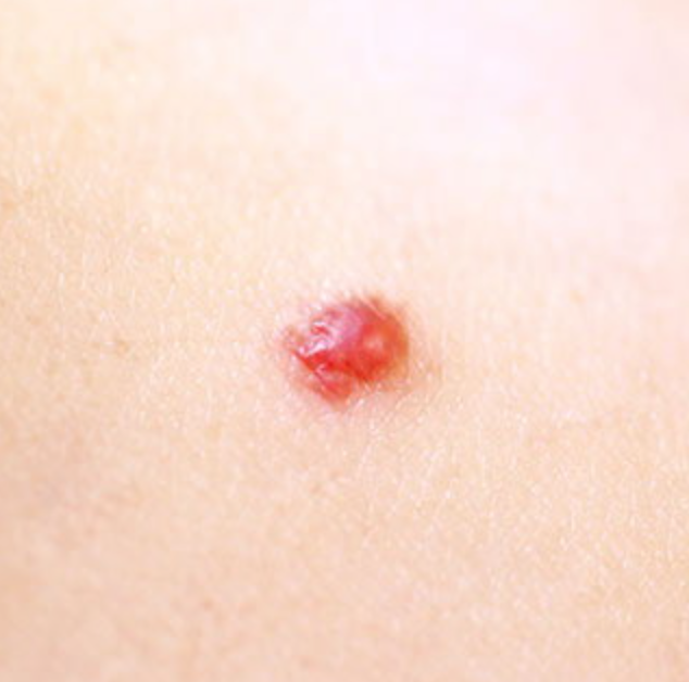 Cherry Angioma: Causes, Symptoms, Treatment, and Prevention