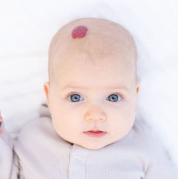 Infantile Hemangiomas: Causes, Symptoms and Treatment