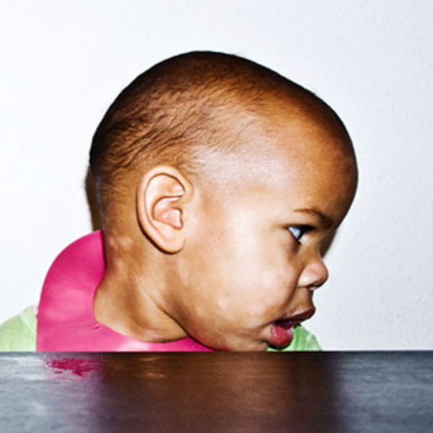 Managing Patchy Skin: Your Guide to Pityriasis Alba | My Skin