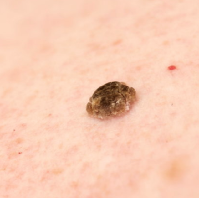 Seborrheic Keratosis: Causes, Symptoms and Treatment