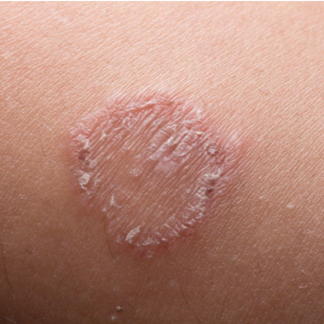 Tinea: A Guide to Different Forms of Fungal Infections