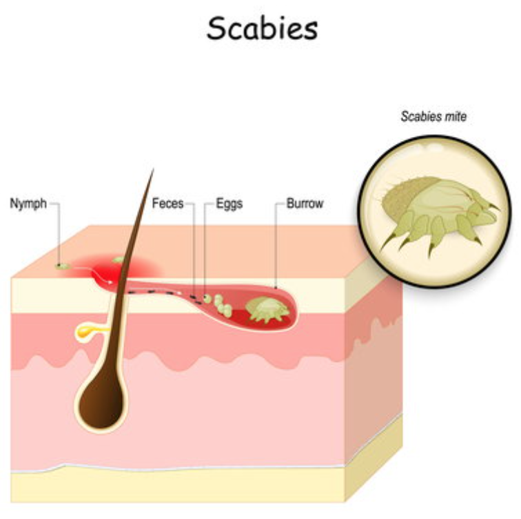 Scabies: Causes, Symptoms and Treatment