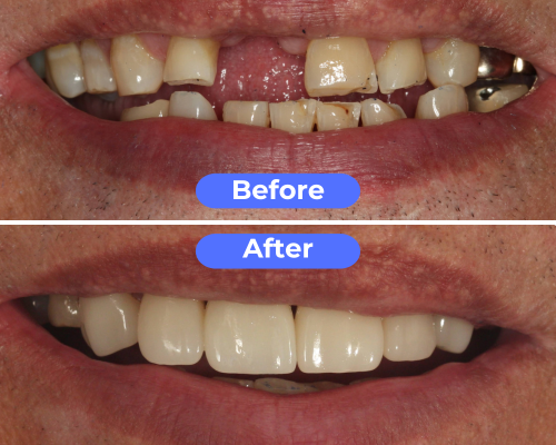 Single Tooth Replacement in Boston | Metro Dental & Implant Studio