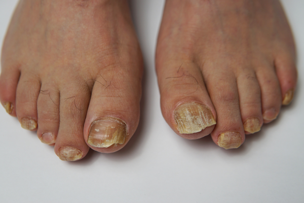How to Handle Recurring Fungal Nail Infections: Long-Term Solutions