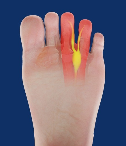 Understanding and Treating Morton's Neuroma Pain