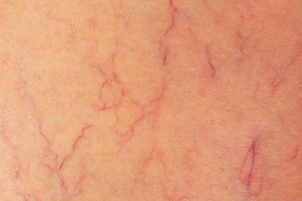 Clinicas y Consultas de Venas y Várices | Dr. Orozco