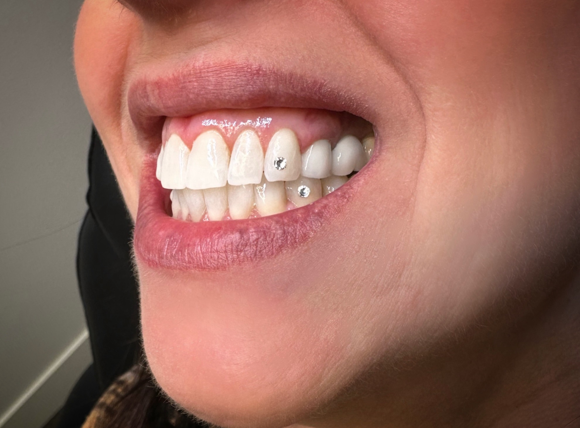 Get Your Best Smile Ever at Icy Teeth Co | Teeth Whitening and Tooth ...