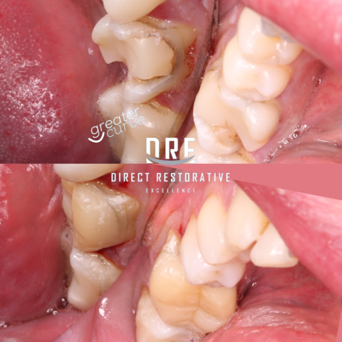 DRE - Direct Restorative Excellence