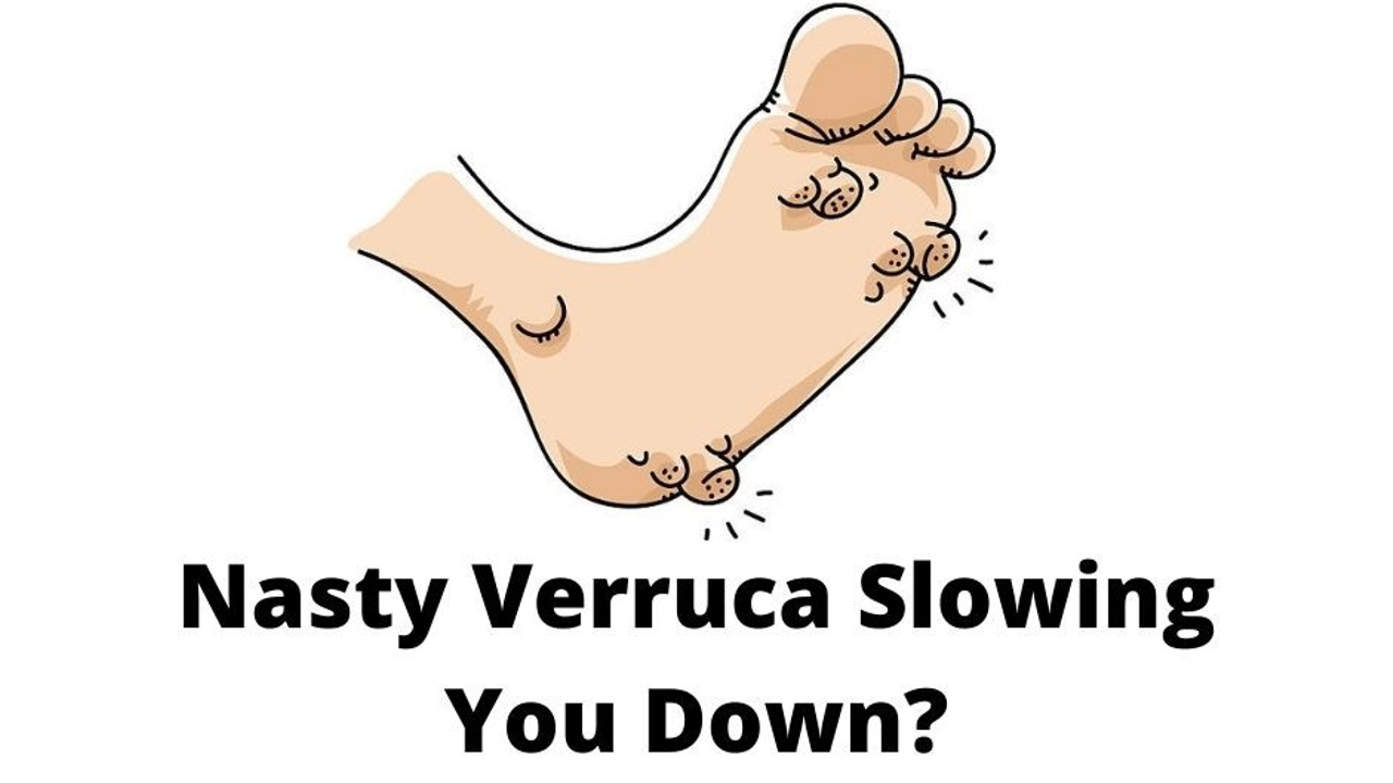 Verruca: What are they and how can they be treated?