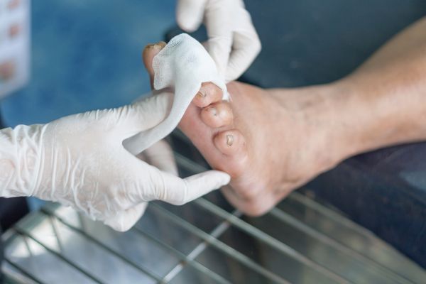 Understanding Foot Ulcers: Causes, Risks, and How to Prevent Complications