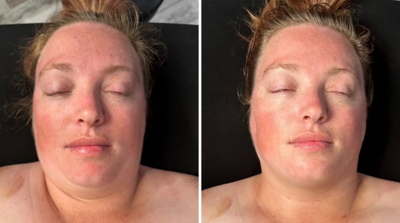 Intra Oral Massage Therapy