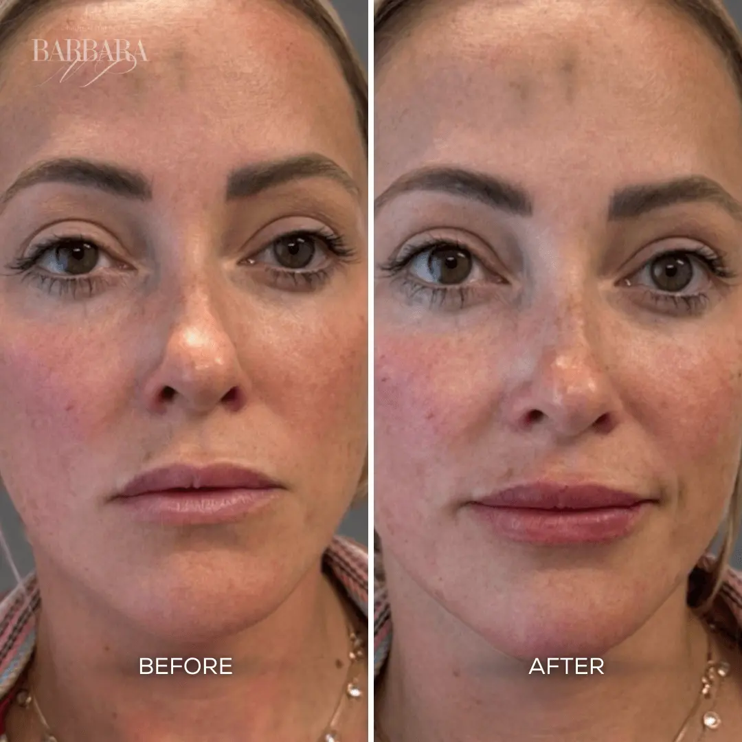 Albuquerque Full Face Balancing Before & After: Chrome Aesthetics