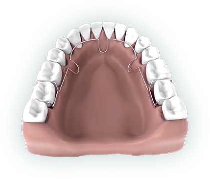 ALF Therapy | ALF Appliance Orthodontics | Early Dental Care