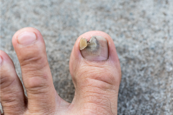 Preventing Toenail Fungus Tips For Healthy Feet