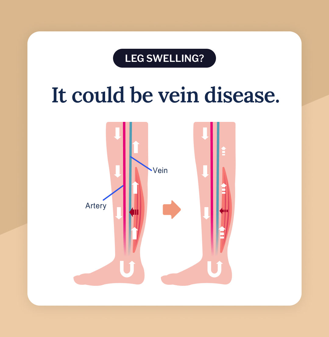 Free Vein Screening | Vein Envy™