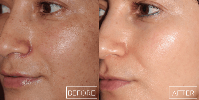 Reveal Cosmetic Laser - BBL laser